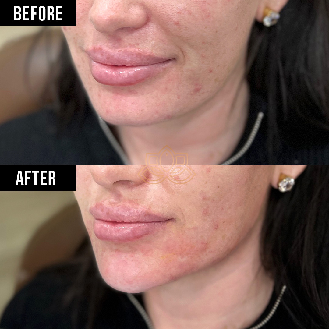 Before and After Gallery - Vive Medical Spa