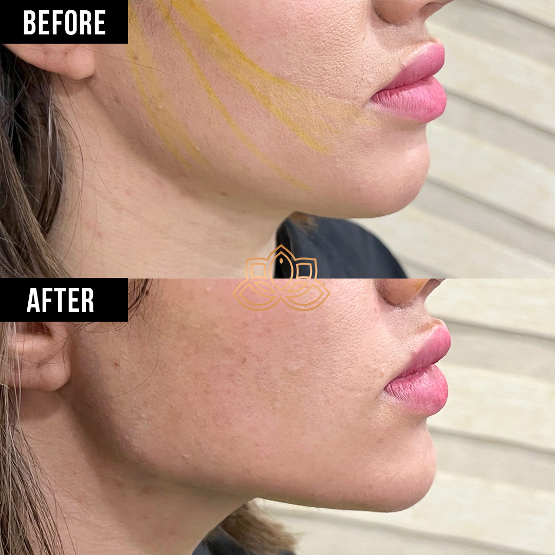 Before and After Gallery - Vive Medical Spa