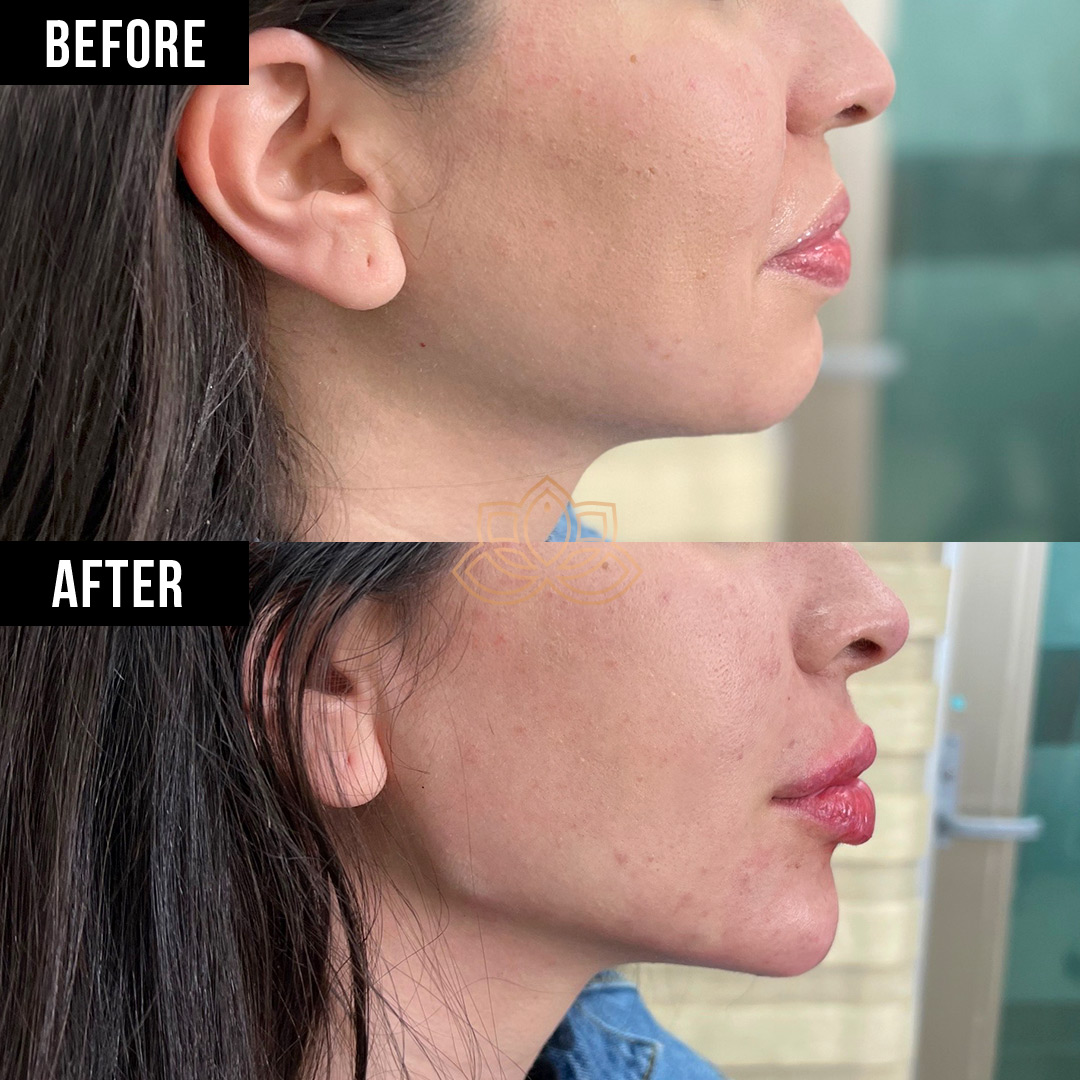 Before and After Gallery - Vive Medical Spa