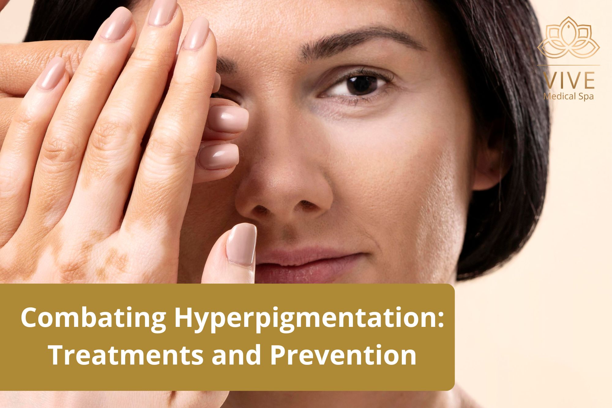 Combating Hyperpigmentation: Treatments and Prevention